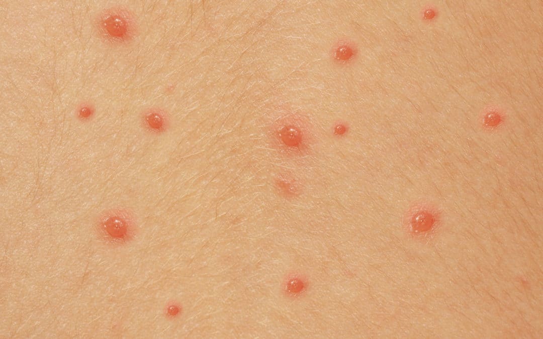 Smallpox Vaccine Scars: Why Do They Happen? - Health Research Policy
