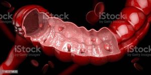 What is Hyperplastic Polyps? - Health Research Policy